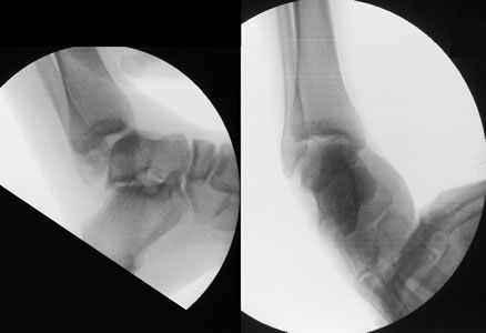 Ankle Sprain and Instability – Ankle to Foot Clinic